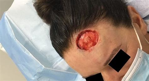 Bcc Upper Forehead Dr Vindy Ghura Dermatologist Manchester