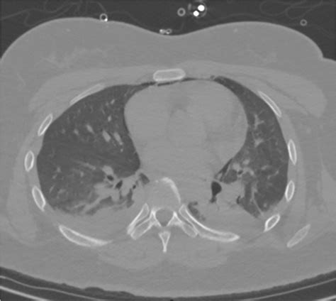 Postoperative Chest Computed Tomography Showing Aspiration Pneumonia