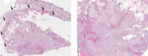 Proliferating Trichilemmal Cyst With Clinical Radiological