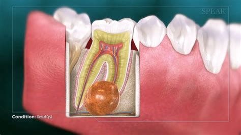 What Is A Gingival Cyst Causes And Symptoms Trust Dental Care