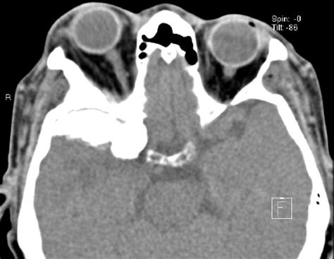 Greater Wing Of Sphenoid Radiograph