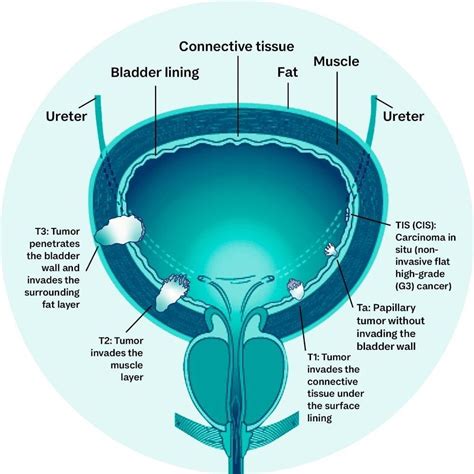 About UROMONITOR Non Invasive Surveillance Of Bladder Cancer