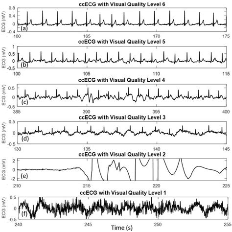 Detection Of Qrs Peaks And Qrs Onset And Offset A Detection Of R Peaks
