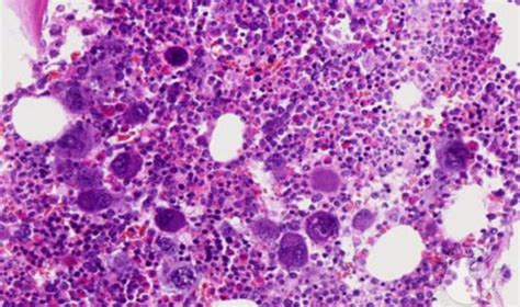 Icl 12 Bone Marrow And Poiesis Flashcards Quizlet