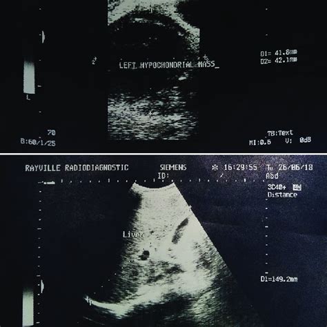 Abdominopelvic Ultrasound Scan Showing A Left Hypochondrial Mass