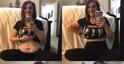 Excess Skin After Weight Loss Pictures