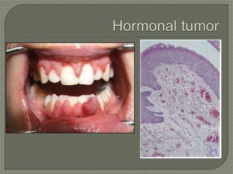 Red Lesion Of Oral Mucosa