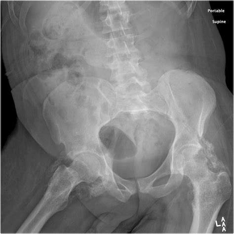 X Ray Demonstrating Mature Heterotopic Ossification At The Hip