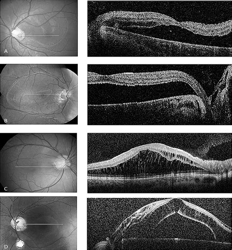 Extent And Location Of Intraretinal And Subretinal Fluid As Retina