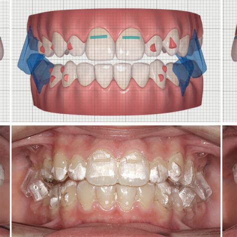 Frontal And Lateral Views Of A Mandibular Advancement Ma Appliance A
