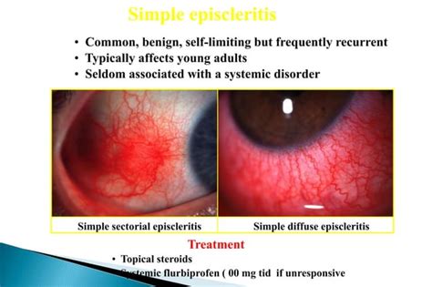 Scleritis Ppt