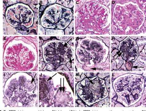 Diffuse Mesangial Sclerosis Disorder Semantic Scholar