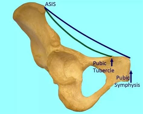 Pubic Tubercle
