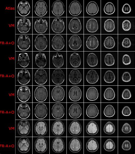 Visual Comparison Between Voxelmorph And Flowreg Ao The Top Row
