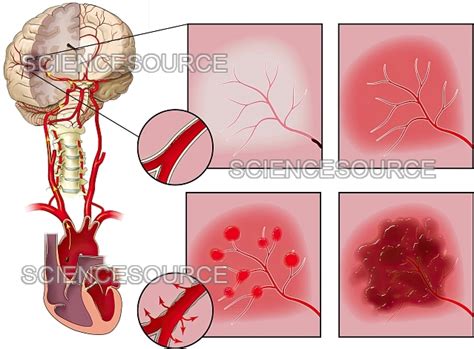 Photograph Progression Of Embolic Stroke Artwork Science Source Images
