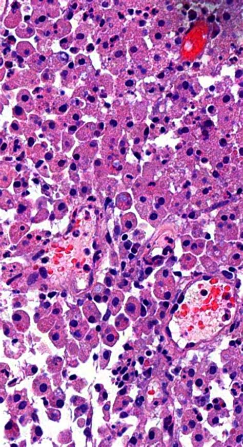 Pathology Of Malakoplakia Histology Slides Pathology Blog