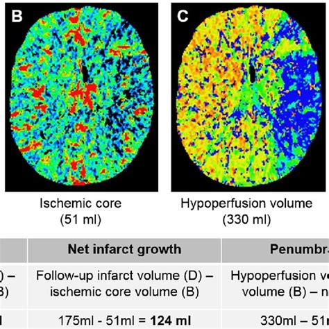 quantification of penumbra salvage volume illustration of the