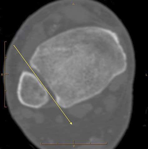 Distal Tibiofibular Radiological Overlap Does It Always Exist Pmc