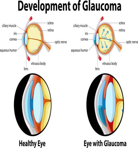 Clip Art Of Eyes With Glaucoma Illustrations Royalty Free Vector