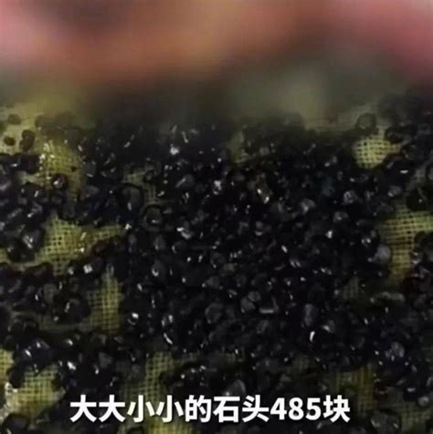 衡水 恐怖！一名28岁的男子体内长了485块黑石块！密密麻麻医生高脂肪建议