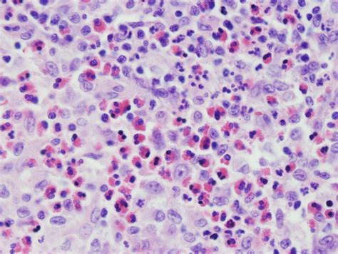 Skin Biopsy Diagnosis Of Langerhans Cell Neoplasms Intechopen