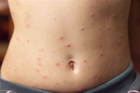 Post Mmr Rash