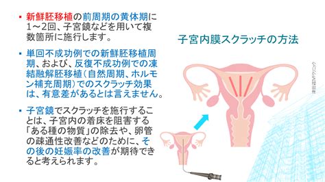 「子宮内膜スクラッチ」 津田沼ivfクリニック Tsudanuma Ivf Clinicのブログ