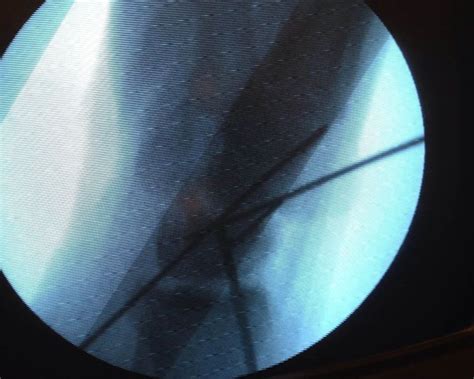 Retro Lunate Dislocation 6 Months Ago Forum 2014