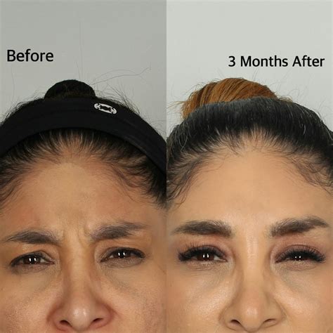 Daxxify Before And After Photos Grossman Dermatology