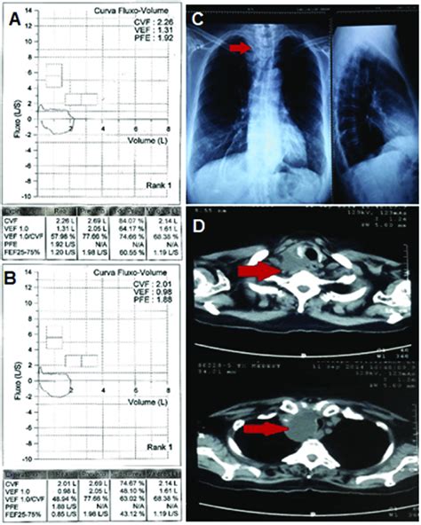 Spirometry Bronchodilator At Adam Goudeau Blog