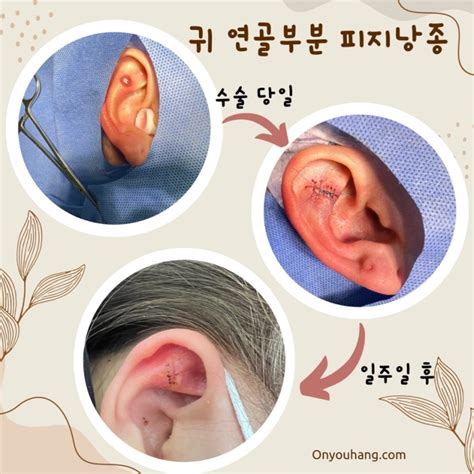 용인 수지 피지낭종 지방종 수술 후기와 똑같은 병원 찾고 계시나요 온유항외과 네이버 블로그
