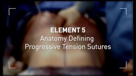 Element 5 Progressive Tension Sutures Youtube
