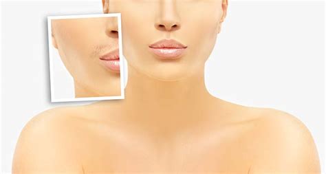 Faire Un épilation Laser De La Lèvre Supérieur Mon Avis