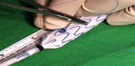 Tailor Made Iliac Branched Device For Preserving The Interna Journal Of The Chinese Medical