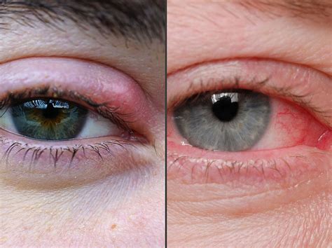 Stye Vs Pink Eye Whats The Difference