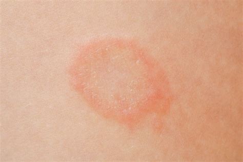 What Does Ringworm Look Like Healthtost