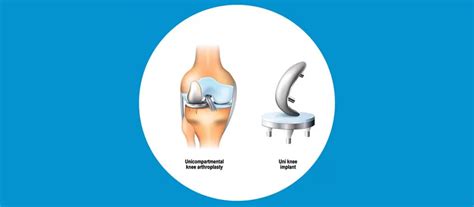 Best Surgeon For Unicondylar Partial Knee Replacement In Mumbai Dadar
