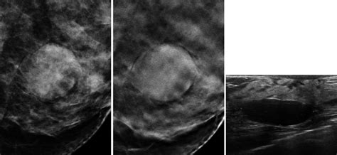 38 Year Old Woman With 25 Cm Benign Phyllodes Tumor A Mediolateral