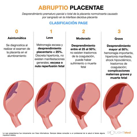 ️ Desprendimiento Prematuro De Placenta Normoinserta Dppni O Abruptio