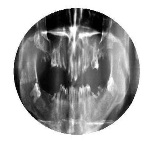 Dental X Ray Object Detection Dataset V1 2024 03 13 1 56pm By Gozdes Projects