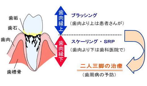 歯周病の治し方治療法ーノーブルデンタルクリニック仙台仙台駅東口・日曜診療・夜間診療