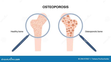 Osteoporosis Medical Poster Cartoon Vector 295706051