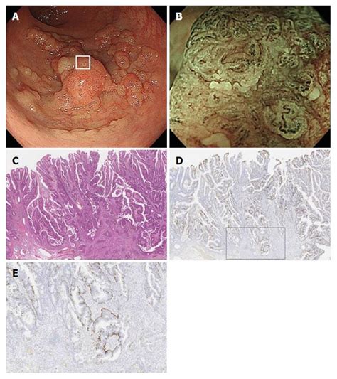 White Spots On Colonoscopy Pictures At Miguel Price Blog