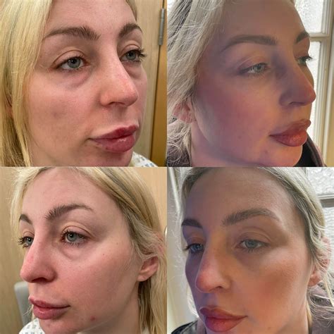 Under Eye Bags Before And After Results Non Surgical Solutions