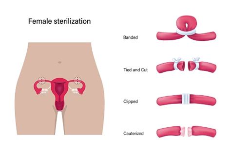 난관 결찰 절차의 유형 벡터 여성 살균 줄무늬 묶고 자르고 자르고 자르고 소작합니다 Tubal Ligation에 대한 스톡 벡터