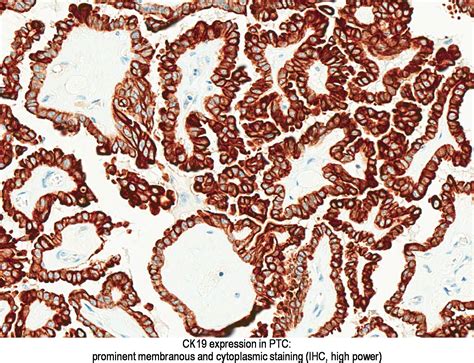 Pathology Outlines Papillary Carcinoma General