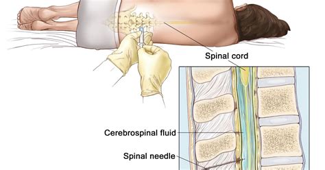 Sri Lankan Nurse Cerebrospinal Fluid CSF Analysis