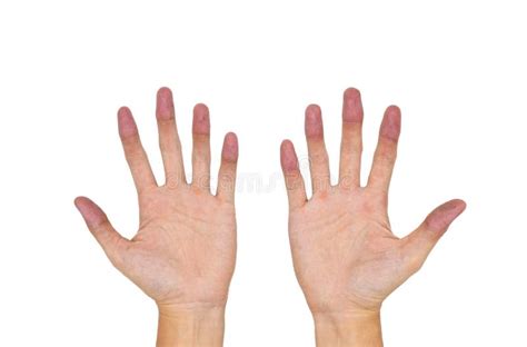 Cyanotic Hands Or Peripheral Cyanosis Or Blue Hands At Asian Man Stock