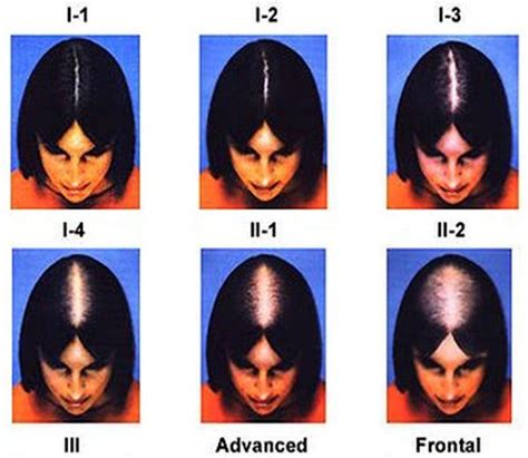 Diffuse Alopecia I Unit Combined Protocol