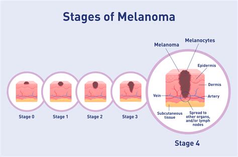 Advanced Melanoma Melanoma Focus